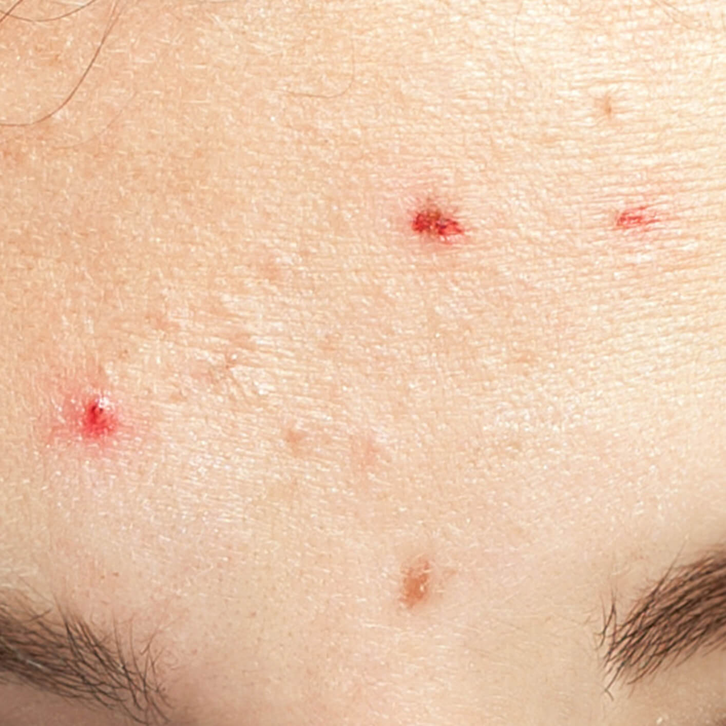 Acné Excoriée des Jeunes Filles - Van Schuppen Huidtherapie Sneek