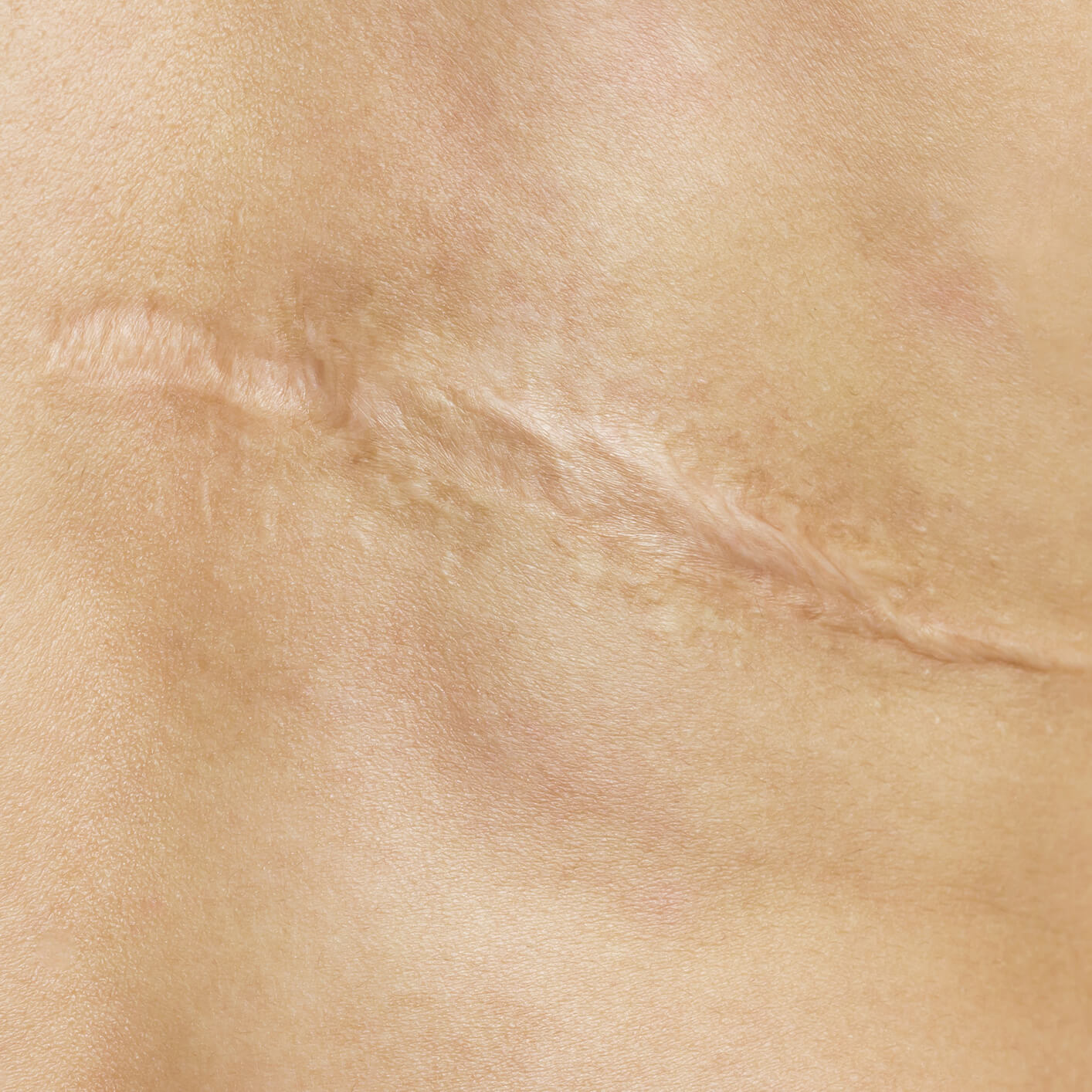Cosmetisch storende littekens - Van Schuppen Huid- Lasertherapie Sneek