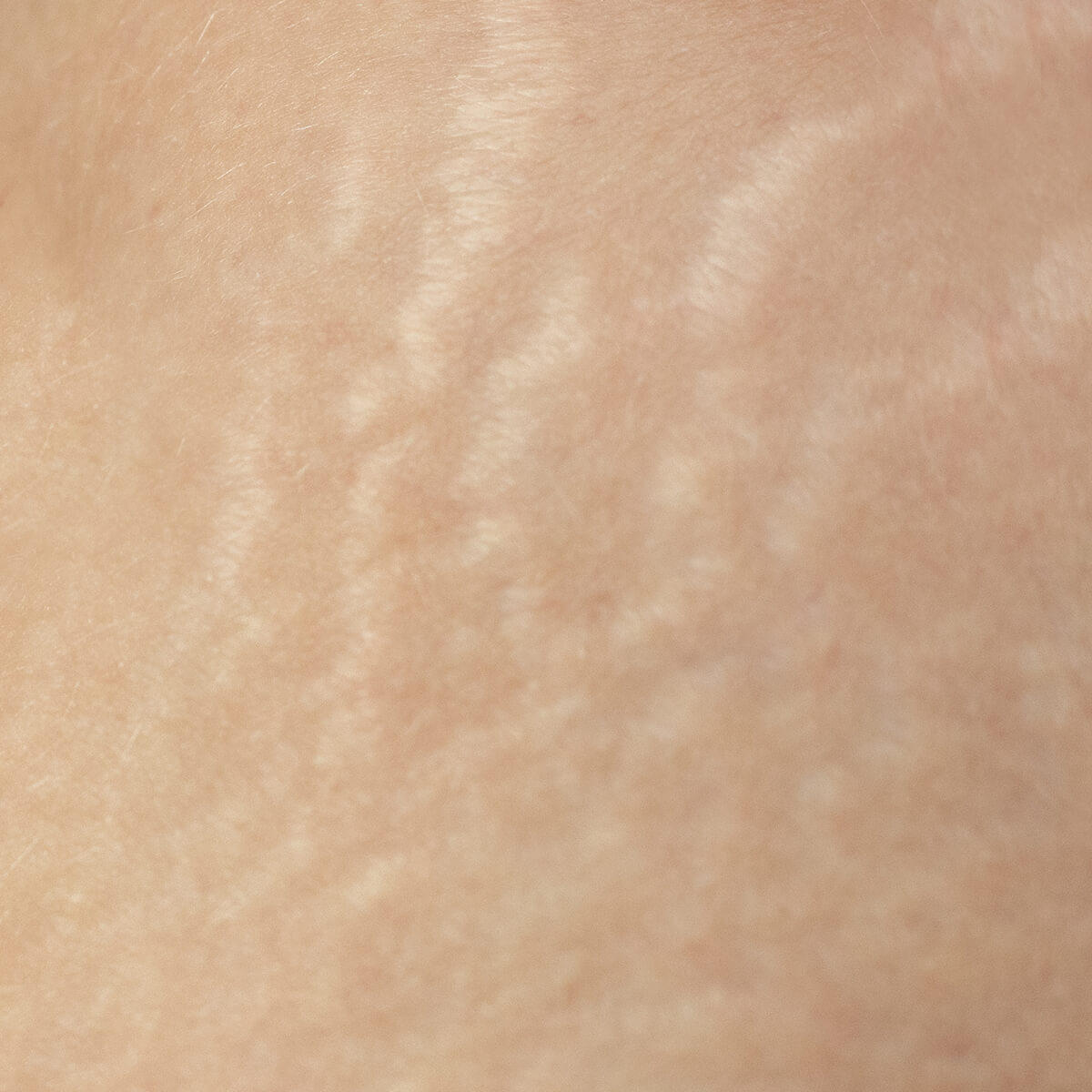 Striae - Van Schuppen Huidtherapie en Laserkliniek Sneek Friesland