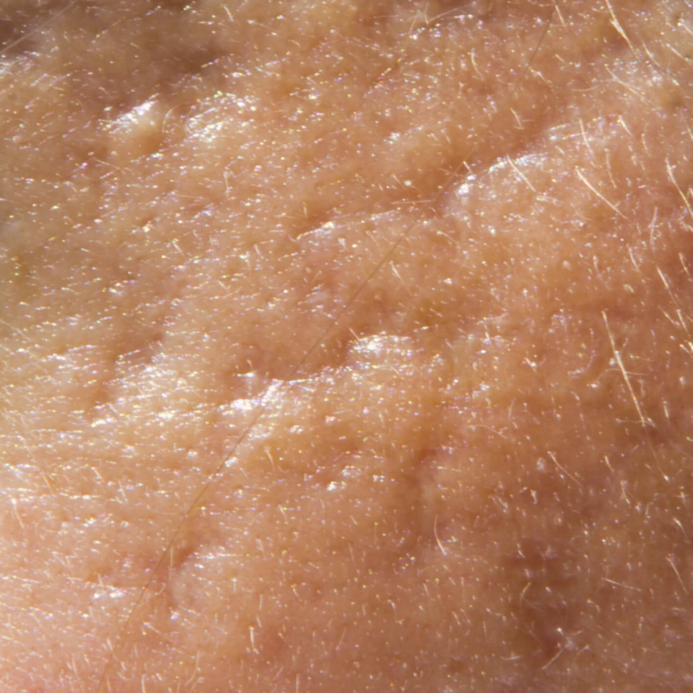 Acne Littekens - Van Schuppen Huid-, Oedeem, en Laserkliniek Sneek