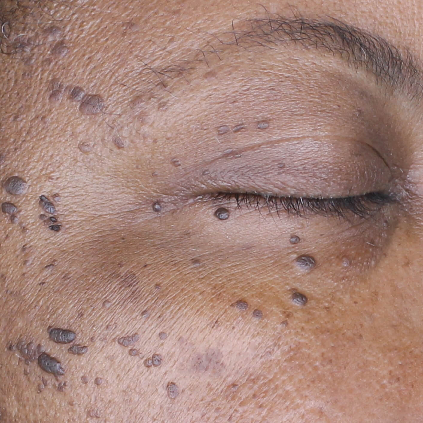 Goedaardige Huidtumoren - Van Schuppen Huid- en Laserkliniek Sneek