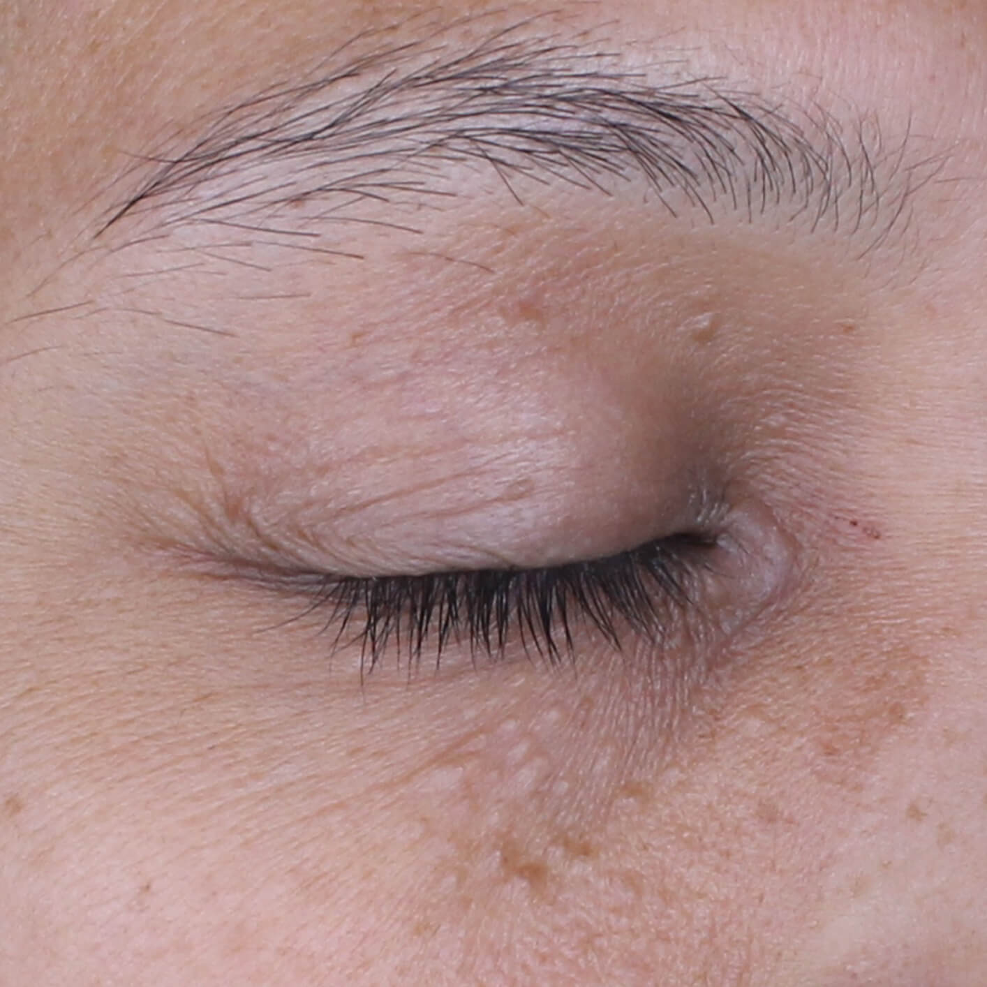 Syringomen - Van Schuppen Huidtherapie Laserkliniek Sneek Friesland