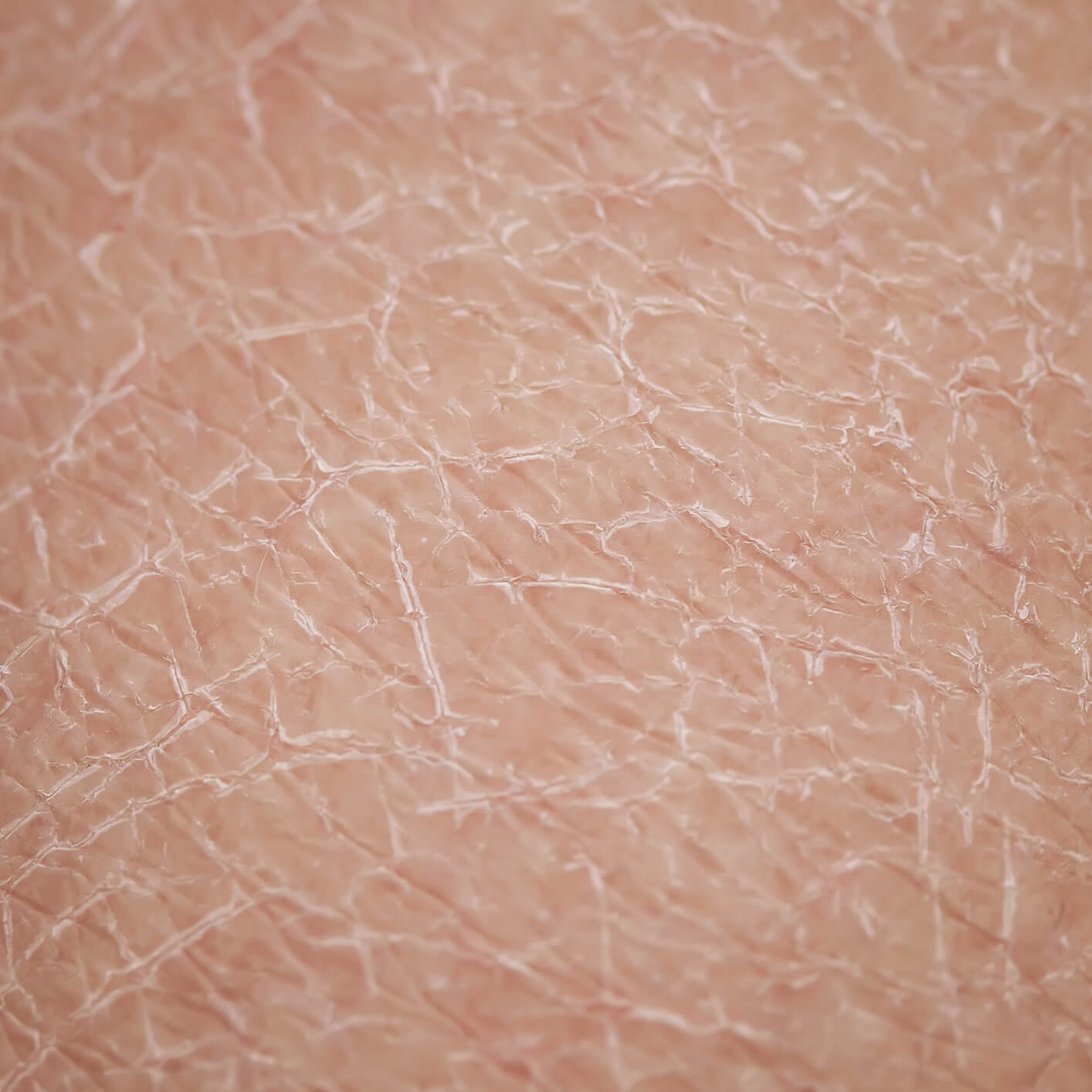 Droge huid - Van Schuppen Huidtherapie & Laserkliniek Sneek Fryslân