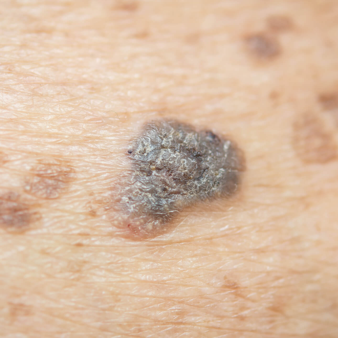 Ouderdomswratten - Van Schuppen Huidtherapie & Laserkliniek Sneek